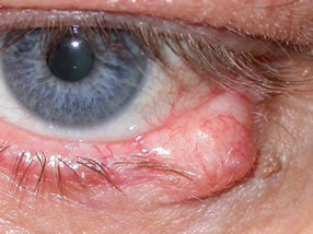 Pictures of Skin Cancer | New Health Advisor