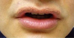 7 Causes of White Dots on Lips (with Pictures) | New Health Advisor