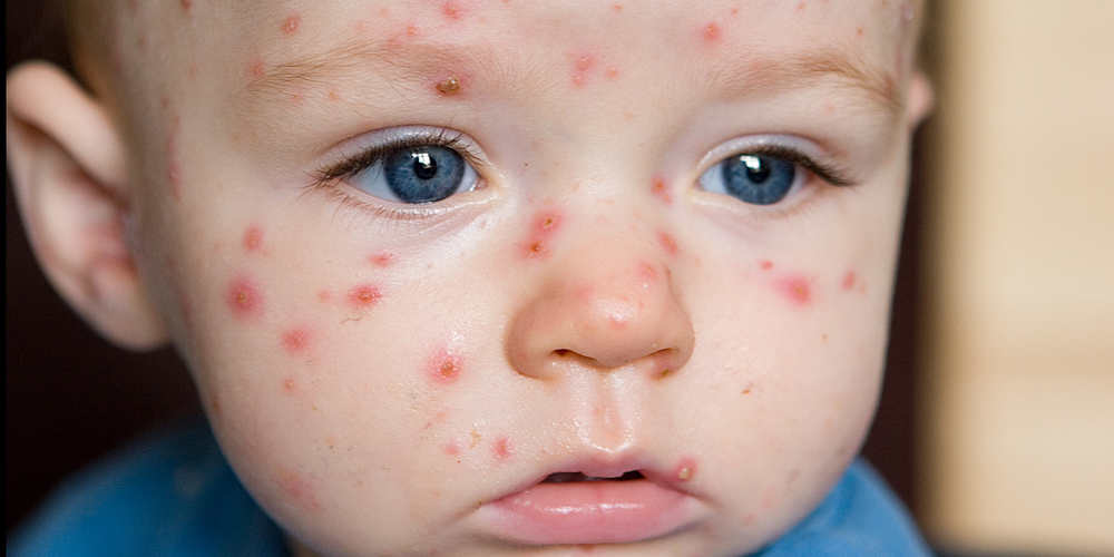 Chickenpox Symptoms, Causes and Treatment | New Health Advisor