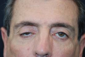 Different Eye Sizes: Causes & Treatments | New Health Advisor