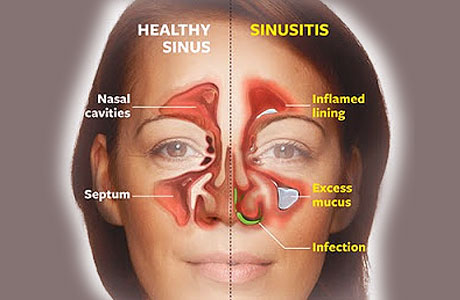 Symptoms of Sinusitis and How to Get Relief | New Health Advisor