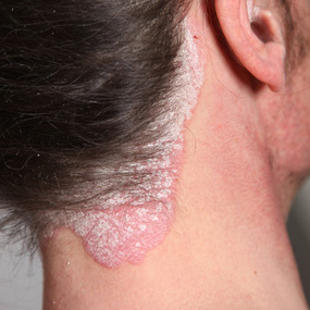 Scaly Skin: Causes and Dealing Ways | New Health Advisor