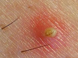 Dealing Ways for Infected Ingrown Hair on Bikini Line | New Health Advisor