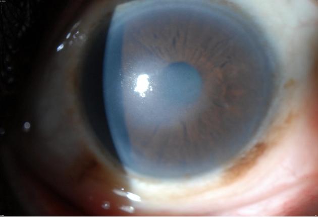Fuchs' Dystrophy: Symptoms, Detection & Treatments | New Health Advisor