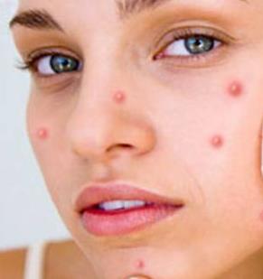 What Causes Pimples? | New Health Advisor