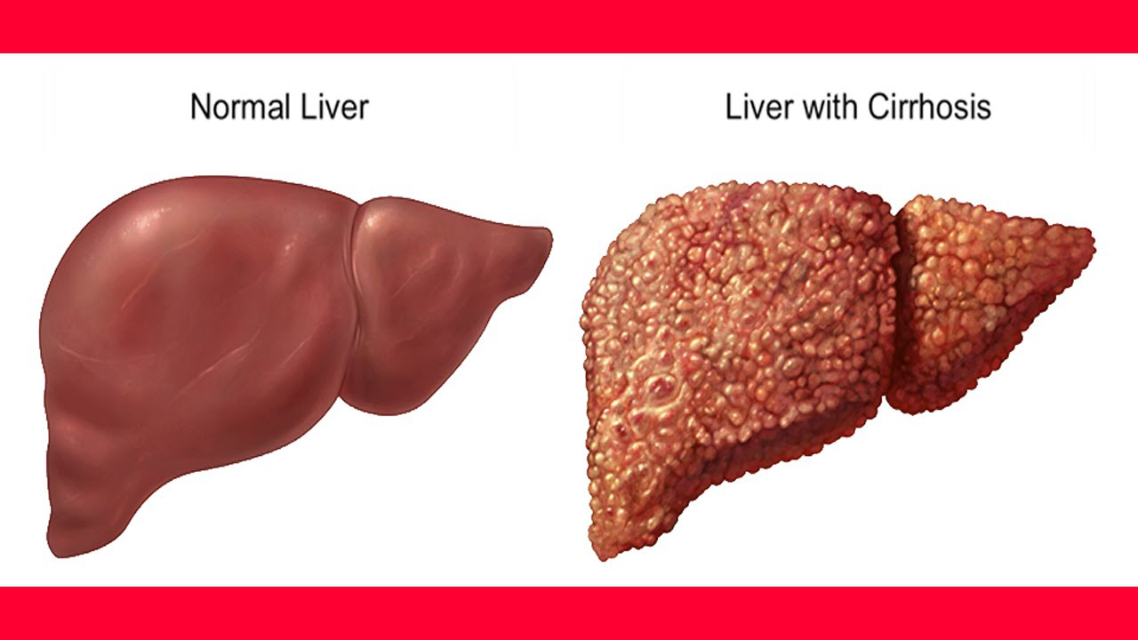 What Is the Life Expectancy of Liver Cirrhosis? | New Health Advisor