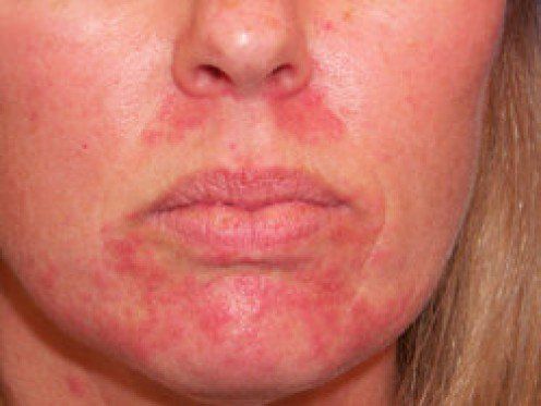 Facial Rash: Causes and Treatment | New Health Advisor