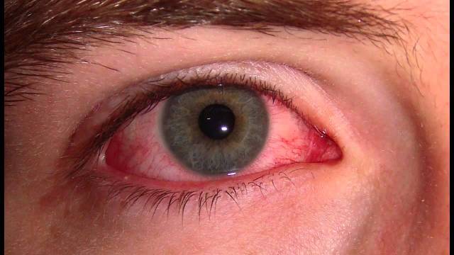 Eyes That Are Bloodshot: Causes and Management | New Health Advisor