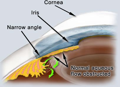 Glaucoma: Narrow Angle Type | New Health Advisor