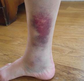 Bruises on Your Legs: Causes and Treatments | New Health Advisor