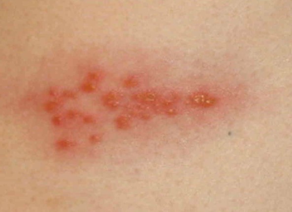 Shingles Without Rash: Causes, Symptoms & Treatments | New Health Advisor