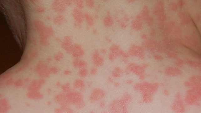 Is Amoxicillin Rash Dangerous? What to Do? | New Health Advisor