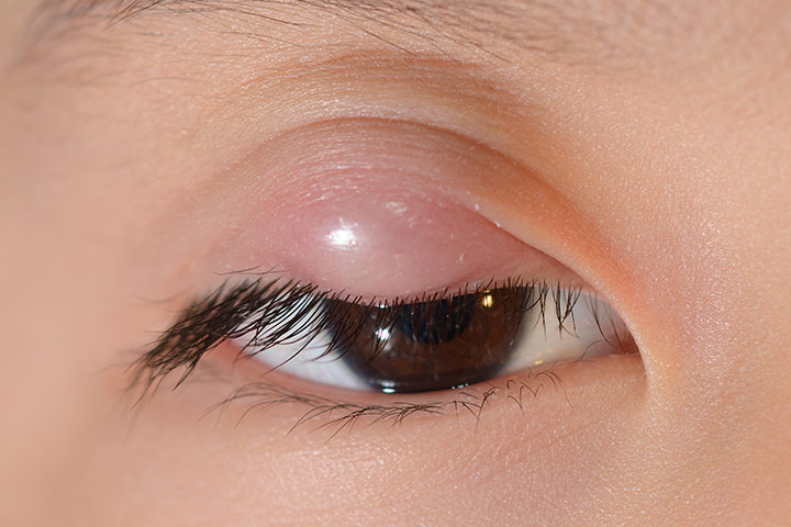 Signs of Stye and Treatments to Get Rid of It | New Health Advisor