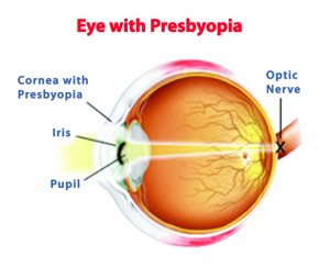 Presbyopia Causes, Symptoms and Treatments | New Health Advisor