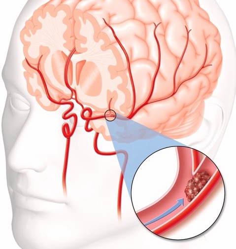 What to Know and Do When Your Brain Has Blood Clots | New Health Advisor
